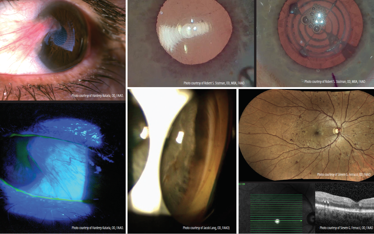The Eye After … - Modern Optometry