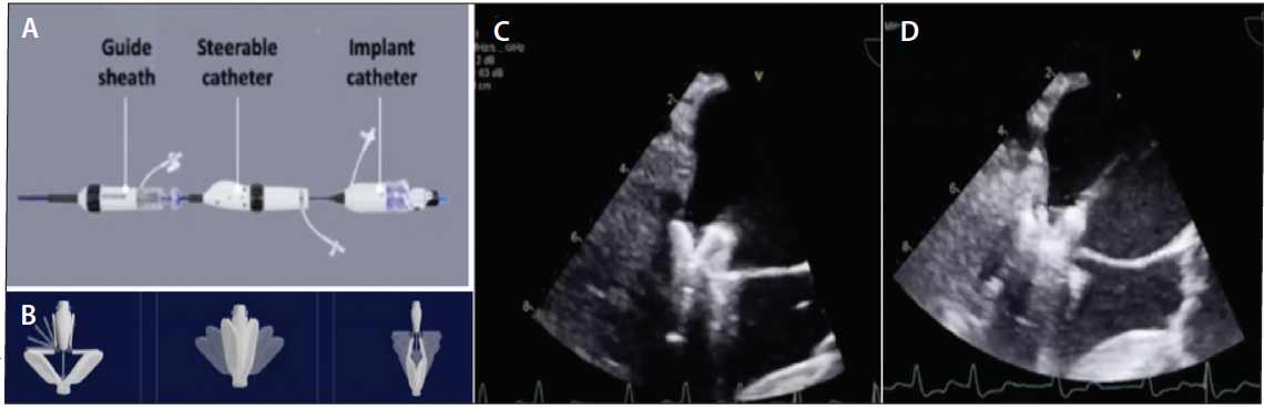 Transcatheter Mitral Valve Repair: For Whom Is It Still Better Than ...