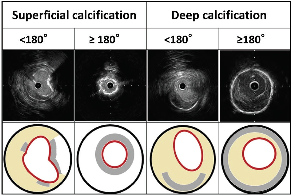The Role of Intravascular Ultrasound in the Endovascular Treatment of ...