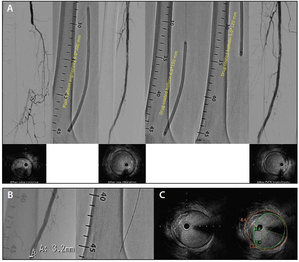 The Role of Intravascular Ultrasound in the Endovascular Treatment of ...