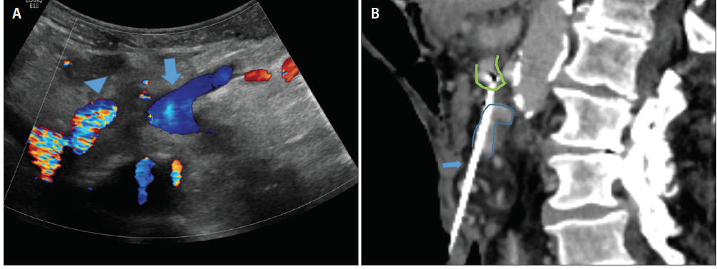 Portomesenteric Intervention in the Cancer Patient - Endovascular Today