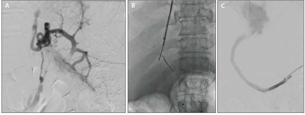 Portomesenteric Intervention in the Cancer Patient - Endovascular Today
