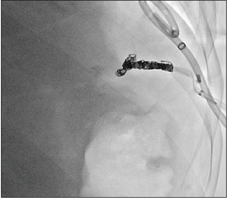Portomesenteric Intervention in the Cancer Patient - Endovascular Today