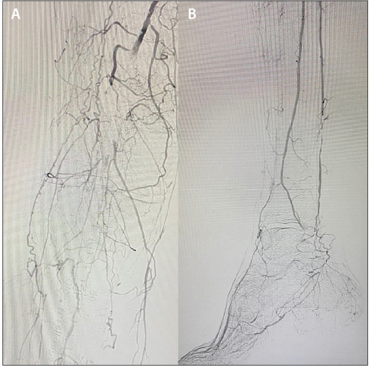 Keeping it REAL: Revascularizing Extremities Against Limb Loss ...