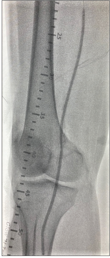 Keeping it REAL: Revascularizing Extremities Against Limb Loss ...