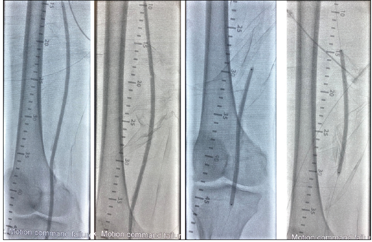 Keeping it REAL: Revascularizing Extremities Against Limb Loss ...