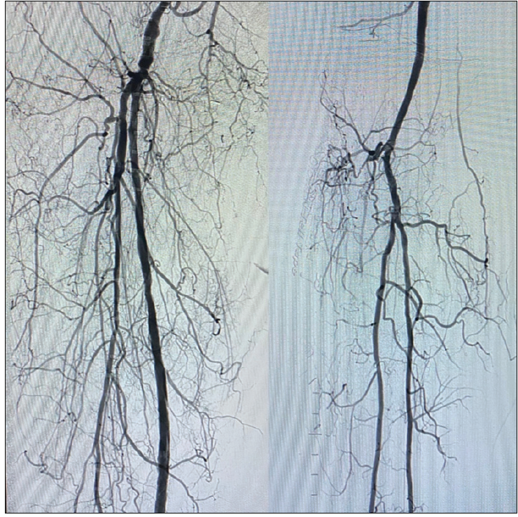 Keeping it REAL: Revascularizing Extremities Against Limb Loss ...