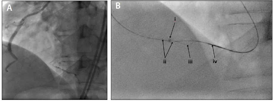 The Dos and Don’ts of Guide Catheter Extensions - Cardiac Interventions ...
