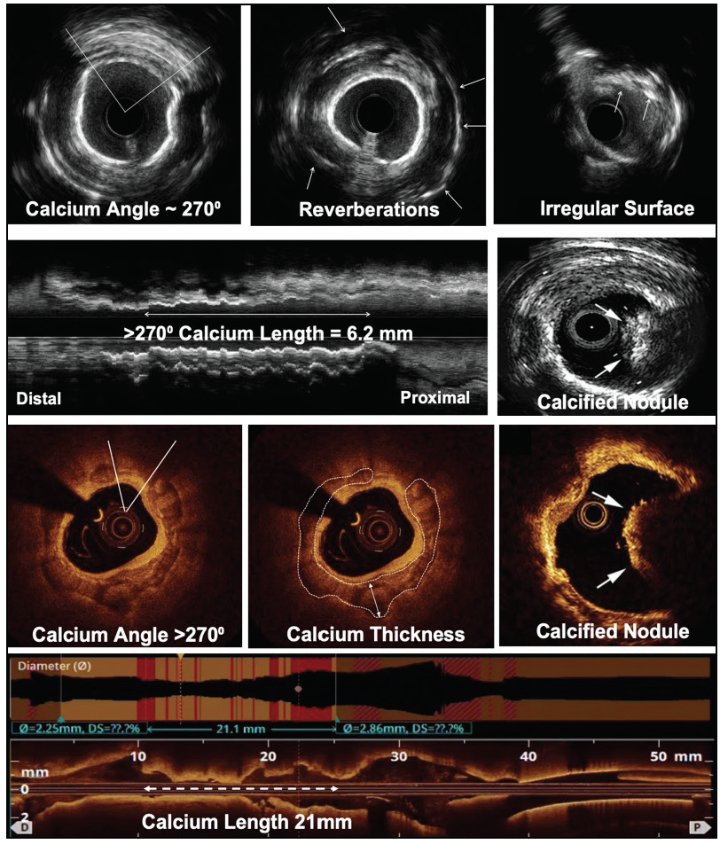 Intravascular Lithotripsy to Modify Calcified Coronary Artery Disease ...