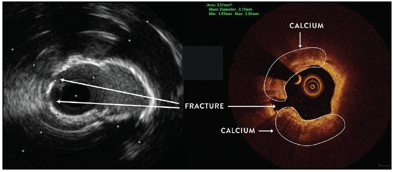 Intravascular Lithotripsy to Modify Calcified Coronary Artery Disease ...