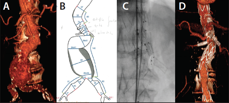 Making the Revolutionary Routine - Endovascular Today