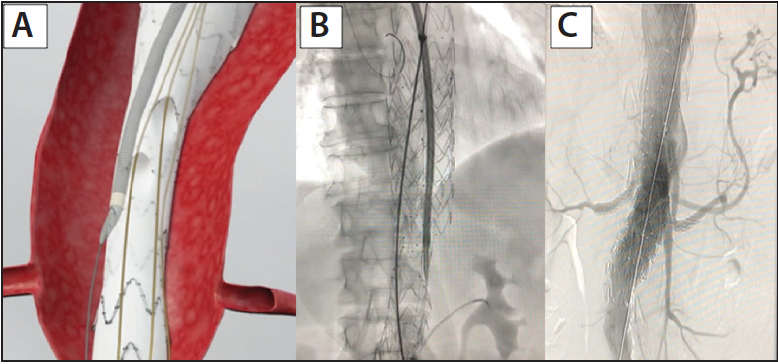 Making the Revolutionary Routine - Endovascular Today