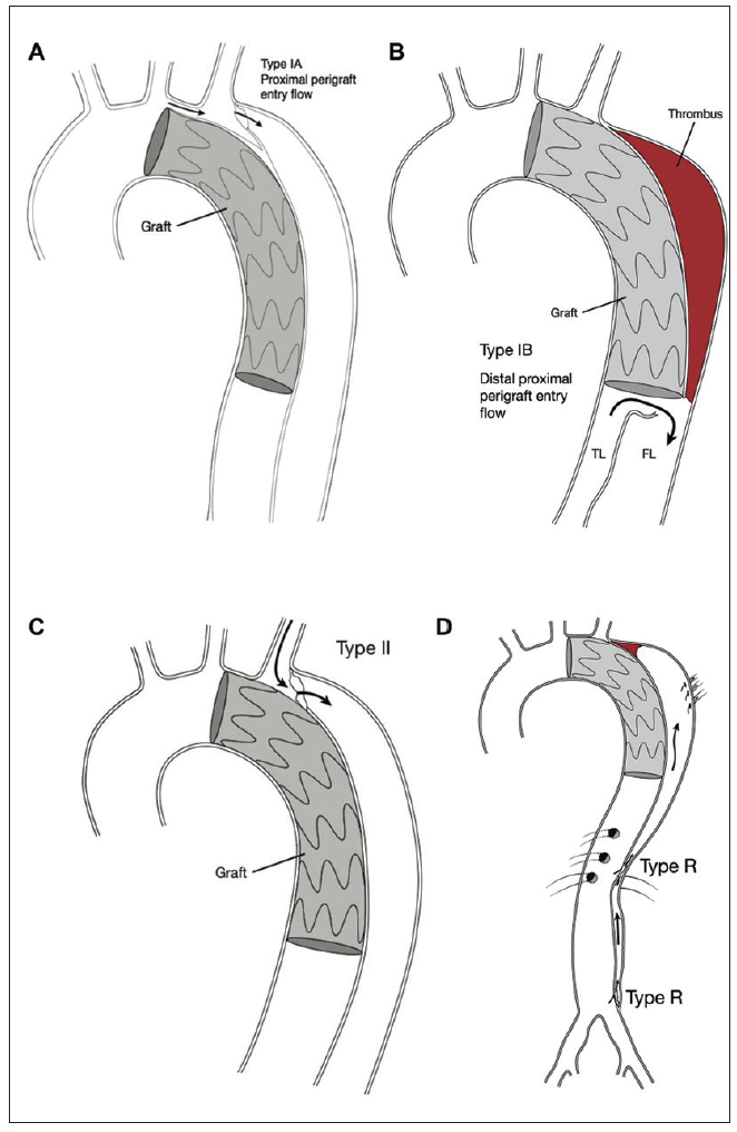 New Aortic Dissection Classification and Practical Real-World ...
