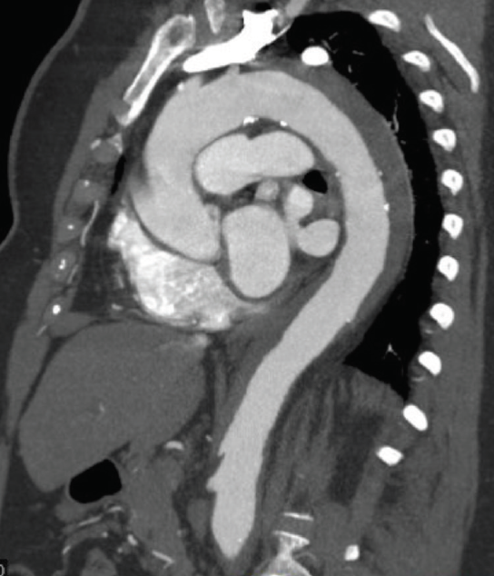 Aortic Intramural Hematomas and Penetrating Aortic Ulcerations ...