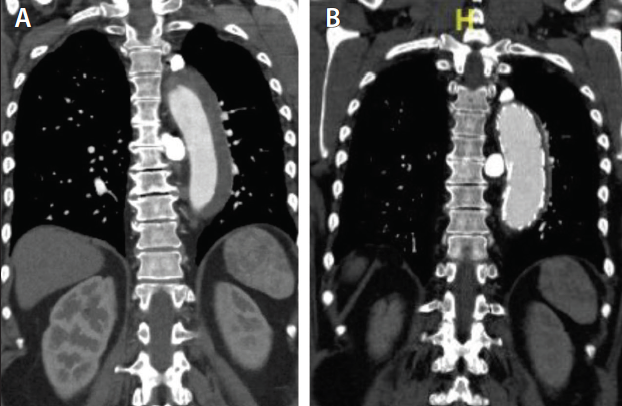 Aortic Intramural Hematomas and Penetrating Aortic Ulcerations ...