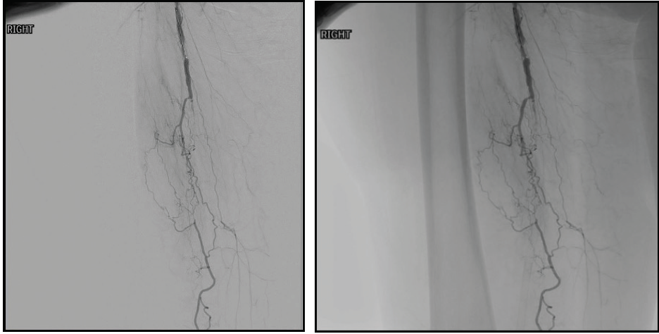 Case Reports: The Auryon Atherectomy System Above and Below the Knee ...