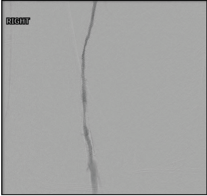 Case Reports: The Auryon Atherectomy System Above and Below the Knee ...