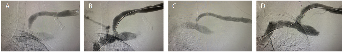 Cephalic Arch Stenoses: A Technology to Leave Nothing Behind ...