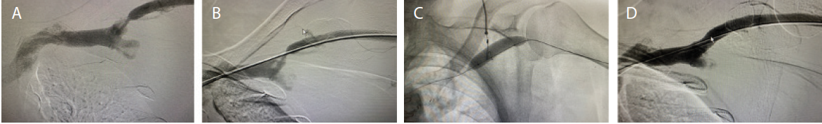 Cephalic Arch Stenoses: A Technology to Leave Nothing Behind ...