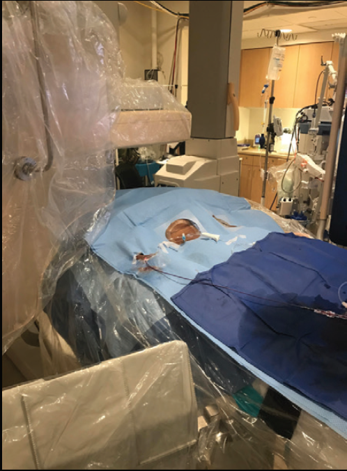 Perspectives on Radial Access Applications: Neurointervention ...