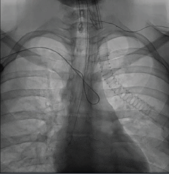 Perspectives on Radial Access Applications: Neurointervention ...