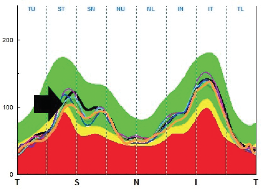 Glaucoma Suspect Identified: Now What? - Modern Optometry