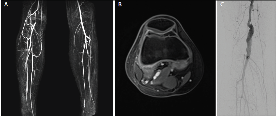 Vascular Emergencies in Athletes - Endovascular Today