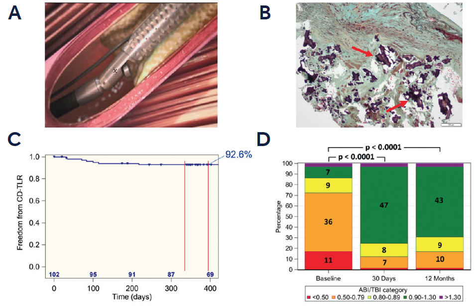 Directional Atherectomy and Drug-Coated Balloon Therapy for Leaving ...