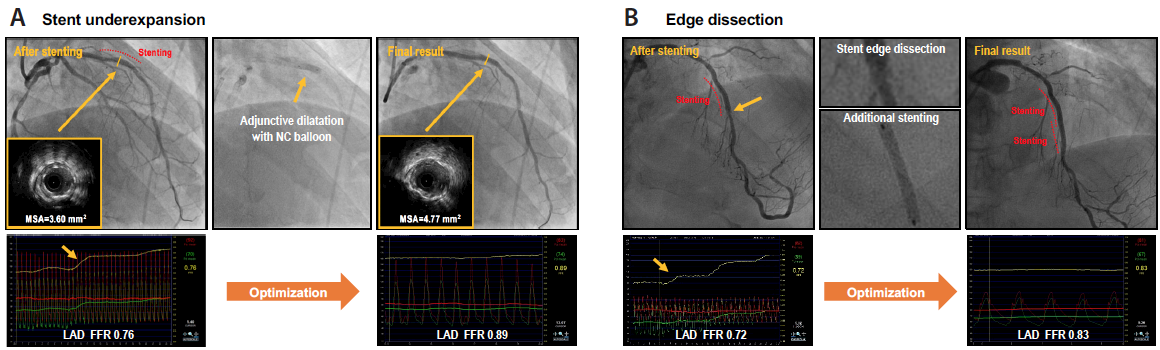 Physiologic Optimization of Revascularization - Cardiac Interventions Today