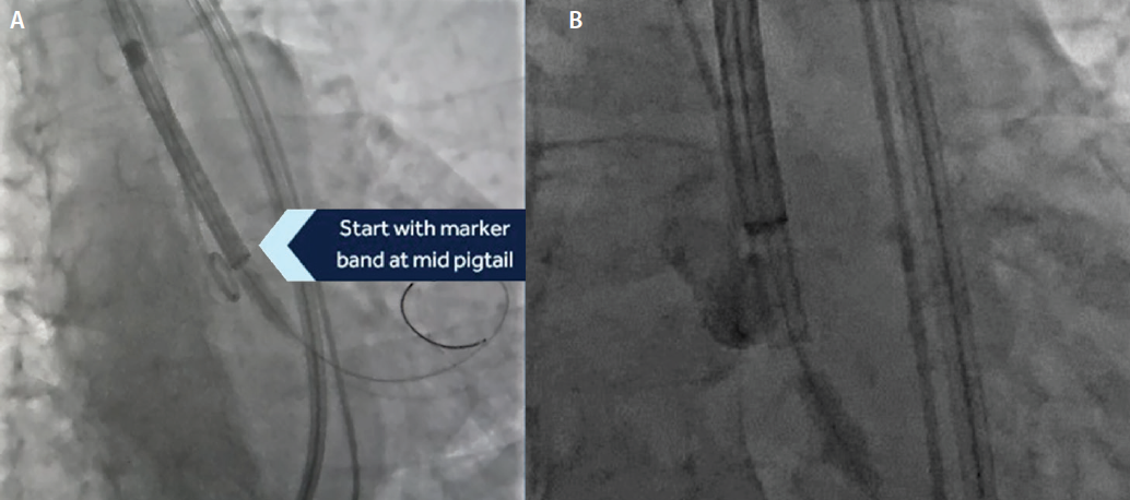 Procedural Optimization to Minimize Interaction With the Left ...