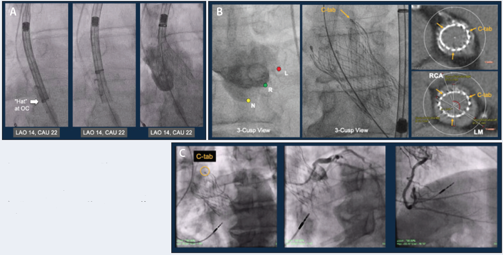 Evolut Commissural Alignment and the Cusp Overlap Technique - Cardiac ...