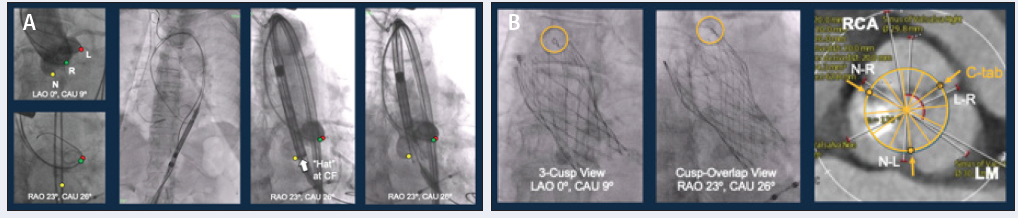 Evolut Commissural Alignment and the Cusp Overlap Technique - Cardiac ...
