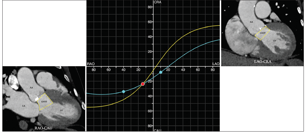 Cusp Overlap Technique In Tavr Cardiac Interventions Today