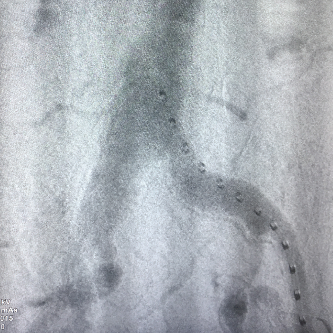Case Study: Advanta V12 large diameter stent - Endovascular Today