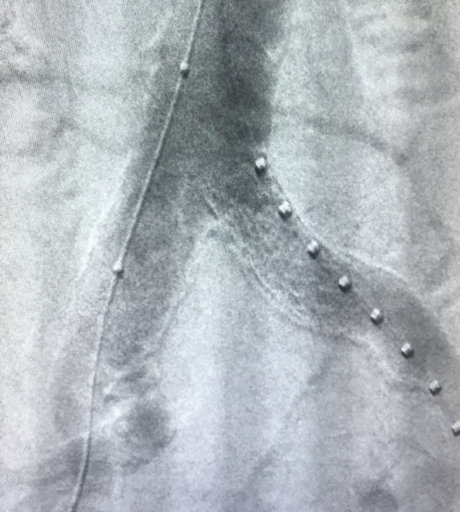 Case Study: Advanta V12 large diameter stent - Endovascular Today