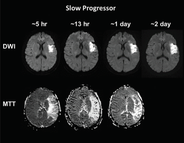Baseline Stroke Core and Time From Onset Metrics: How the Landscape Is ...
