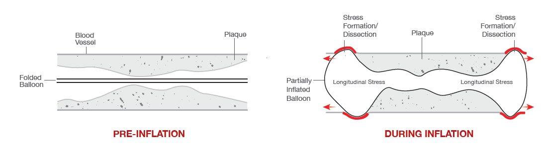 CLTI BTK Intervention With the Chocolate™* PTA Balloon to Minimize Flow ...