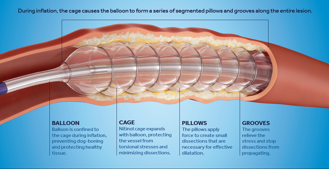 CLTI BTK Intervention With the Chocolate™* PTA Balloon to Minimize Flow ...