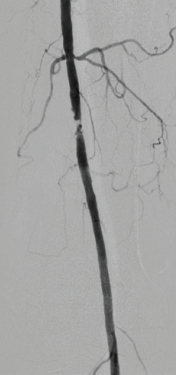 CLTI BTK Intervention With the Chocolate™* PTA Balloon to Minimize Flow ...