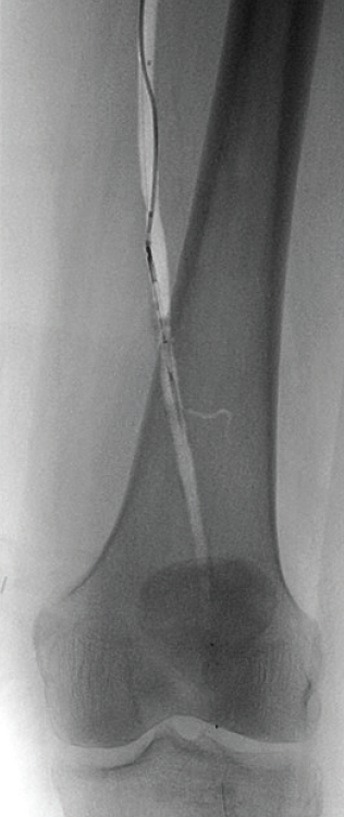 CLTI BTK Intervention With the Chocolate™* PTA Balloon to Minimize Flow ...