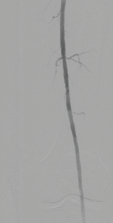 CLTI BTK Intervention With the Chocolate™* PTA Balloon to Minimize Flow ...