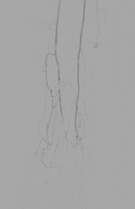 CLTI BTK Intervention With the Chocolate™* PTA Balloon to Minimize Flow ...