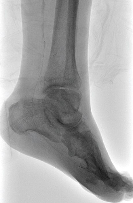 CLTI BTK Intervention With the Chocolate™* PTA Balloon to Minimize Flow ...