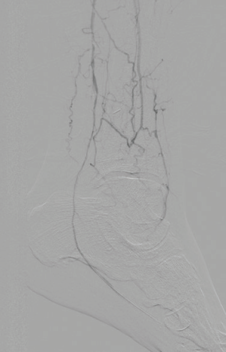 CLTI BTK Intervention With the Chocolate™* PTA Balloon to Minimize Flow ...