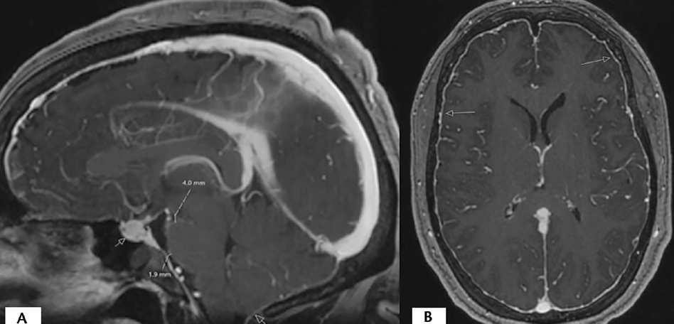 Headache Attributed to Spontaneous Intracranial Hypotension - Practical ...