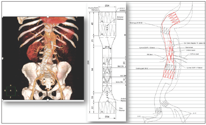Modern Complex Stent Graft Designs: A Closer Look - Endovascular Today