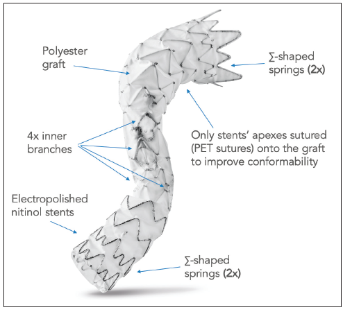 Modern Complex Stent Graft Designs: A Closer Look - Endovascular Today