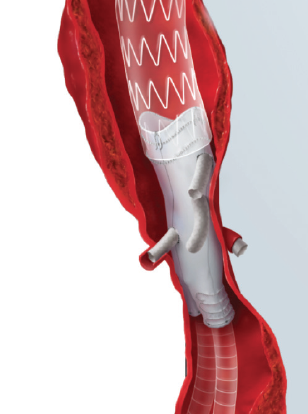 Modern Complex Stent Graft Designs: A Closer Look - Endovascular Today