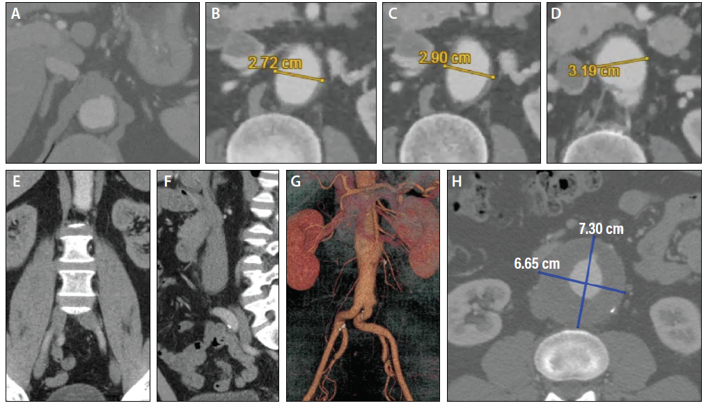 Expert Perspectives on Treatment Approaches in Large-Diameter Necks ...