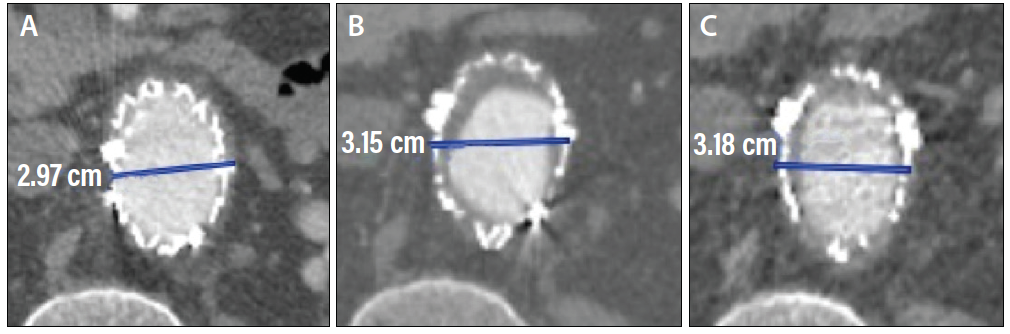 Expert Perspectives on Treatment Approaches in Large-Diameter Necks ...